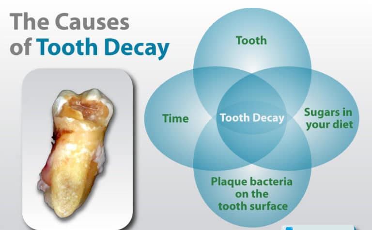 Tooth Decay Causes, Treatment & Prevention - ABC 123 Dental