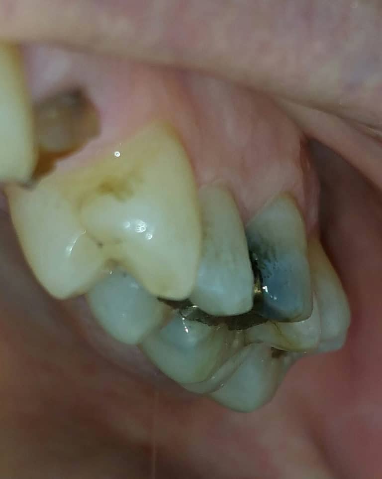 Study Says Focal Infection caused by Teeth Problems