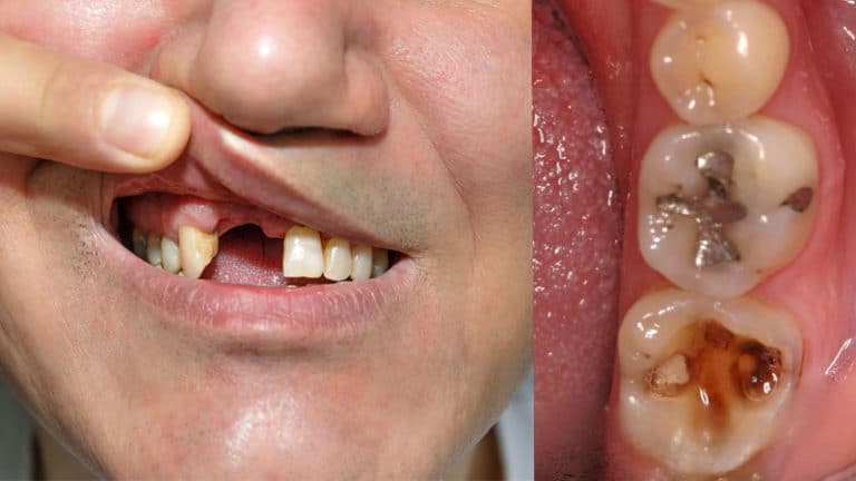 7 Main Causes of Adult Tooth Decay and Loss