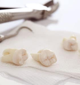 Tooth Extractions in Haltom City | ABC 123 Dental