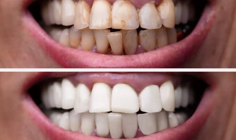 How to whiten yellow teeth? - Dr. Peter Truong Vo