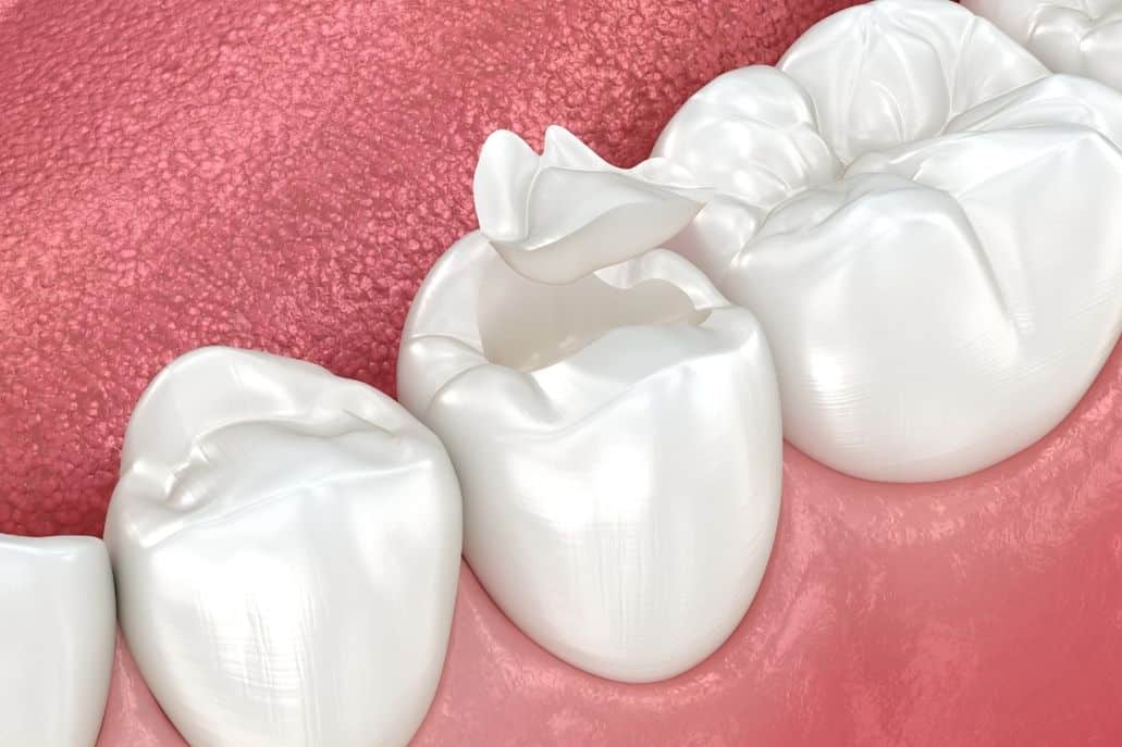 Step-by-Step Process of Tooth Sealants